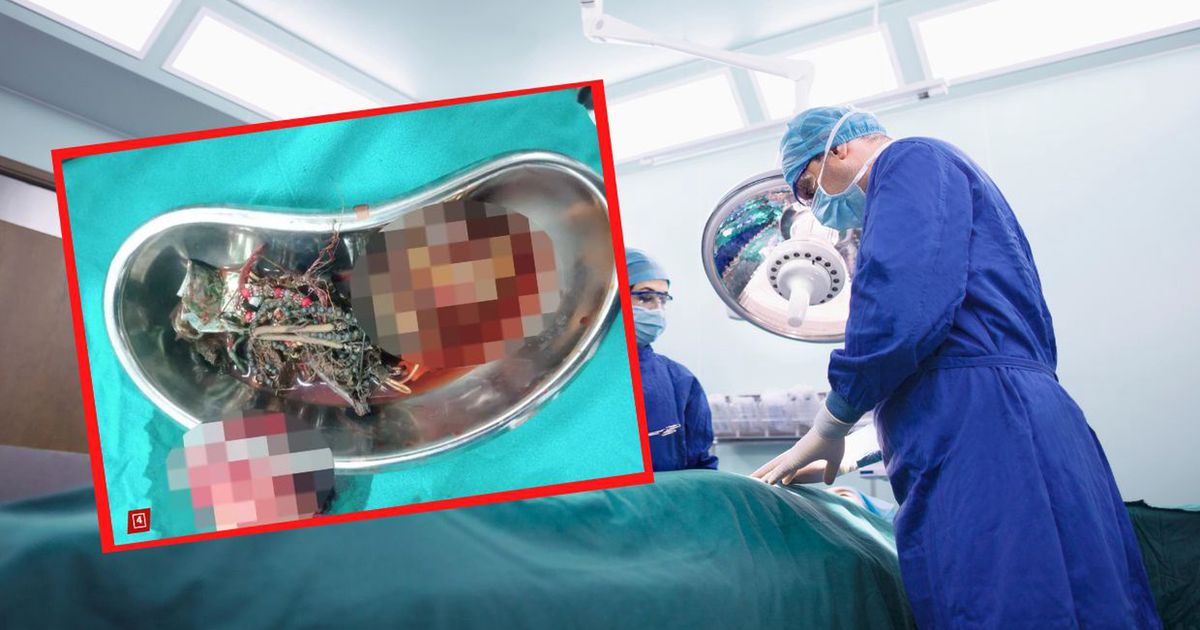 His stomach hurt. The doctors were stunned, found 60 objects inside