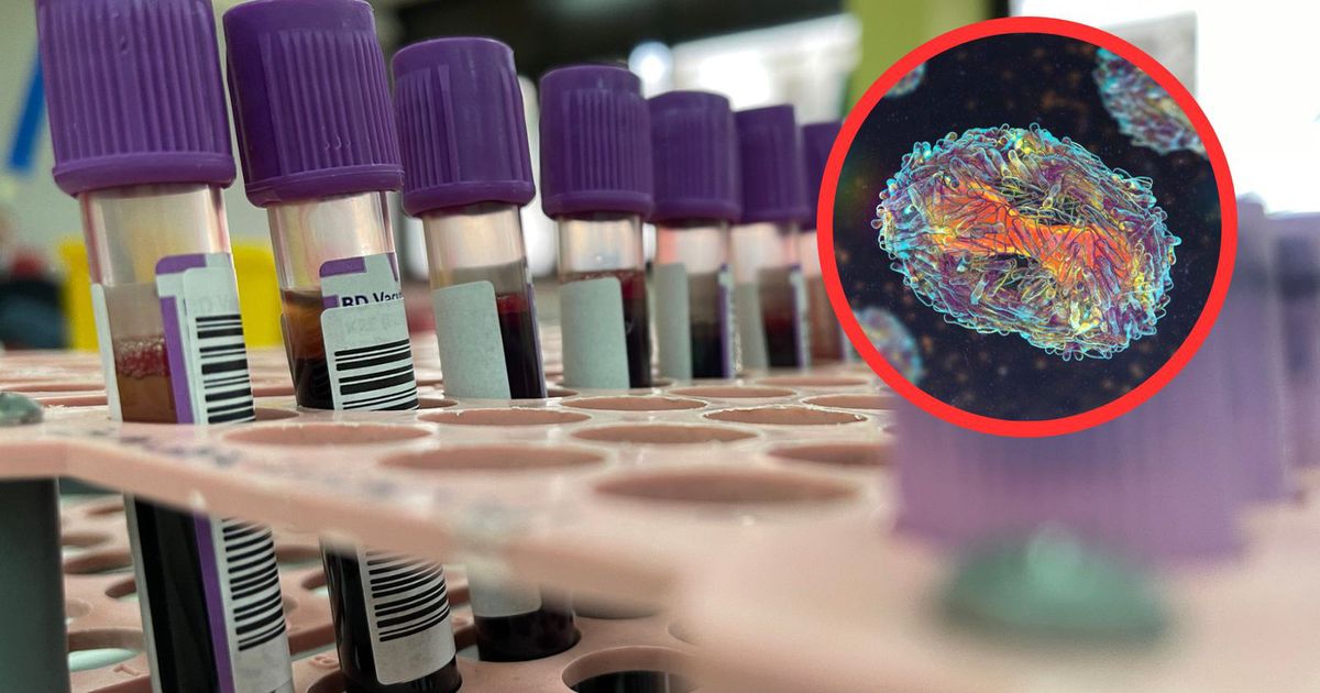 First severe monkeypox case outside Africa confirmed in Sweden