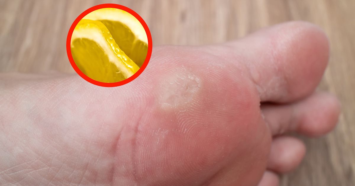 Lemon and chamomile: Simple home remedies for stubborn foot corns