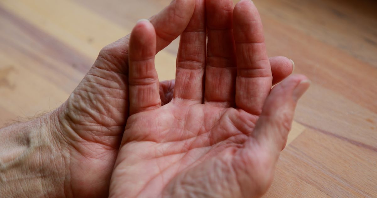 Trigger finger, a startling indicator of diabetes