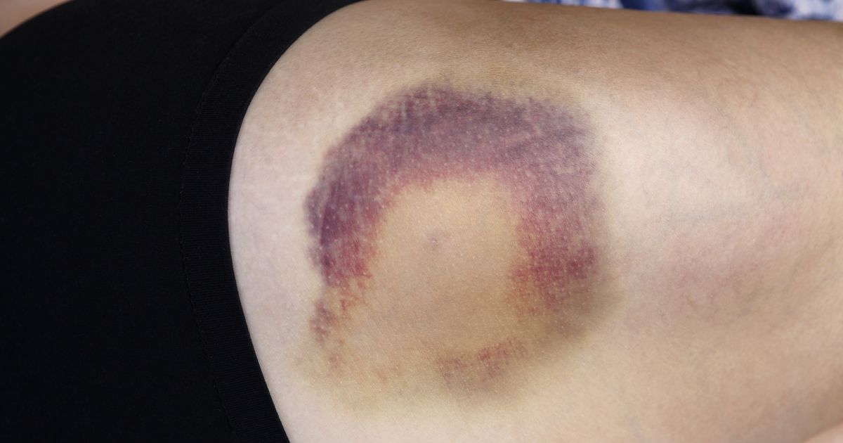 Spontaneous bruising, an unexplored symptom of Anemia, Thrombocytopenia ...