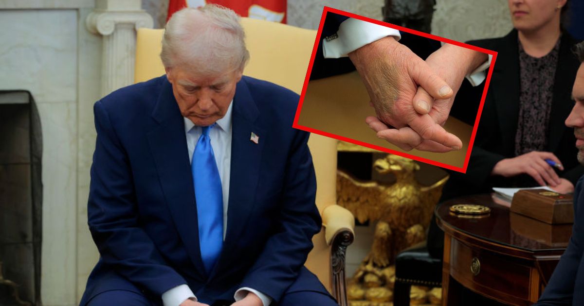 Mystery of Trump's hand bruises: White House clarifies