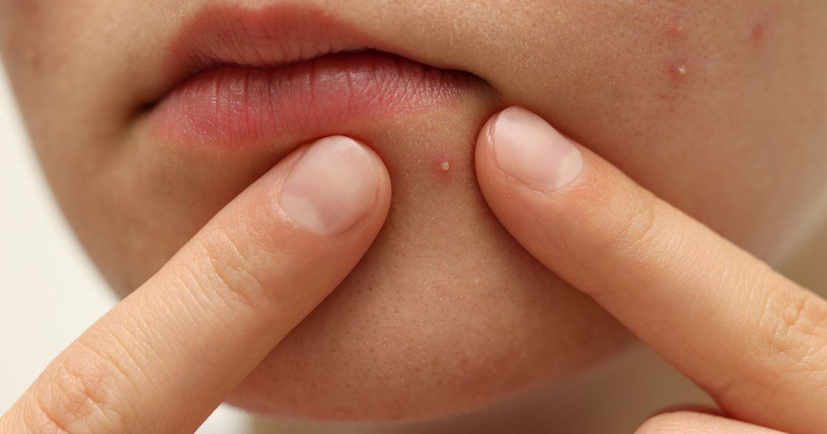 Beware the "triangle of death": Dermatologists warn against pimple popping