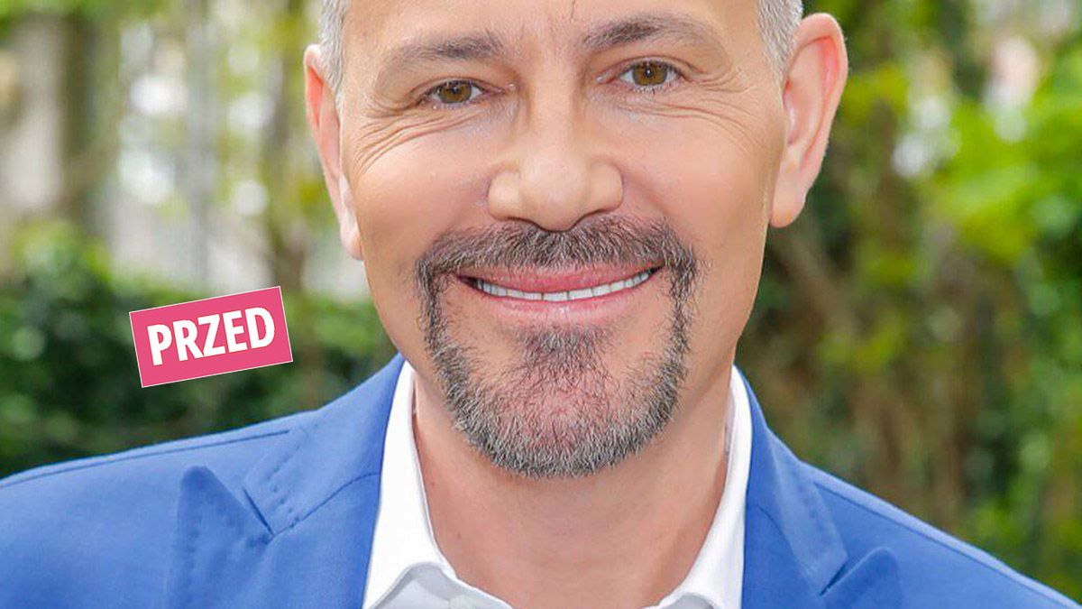 Krzysztof Ibisz majstrował przy twarzy. Pokazał efekt odważnej ...