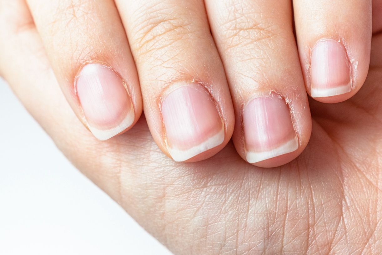 Nail changes: Early warning signs of serious health risks