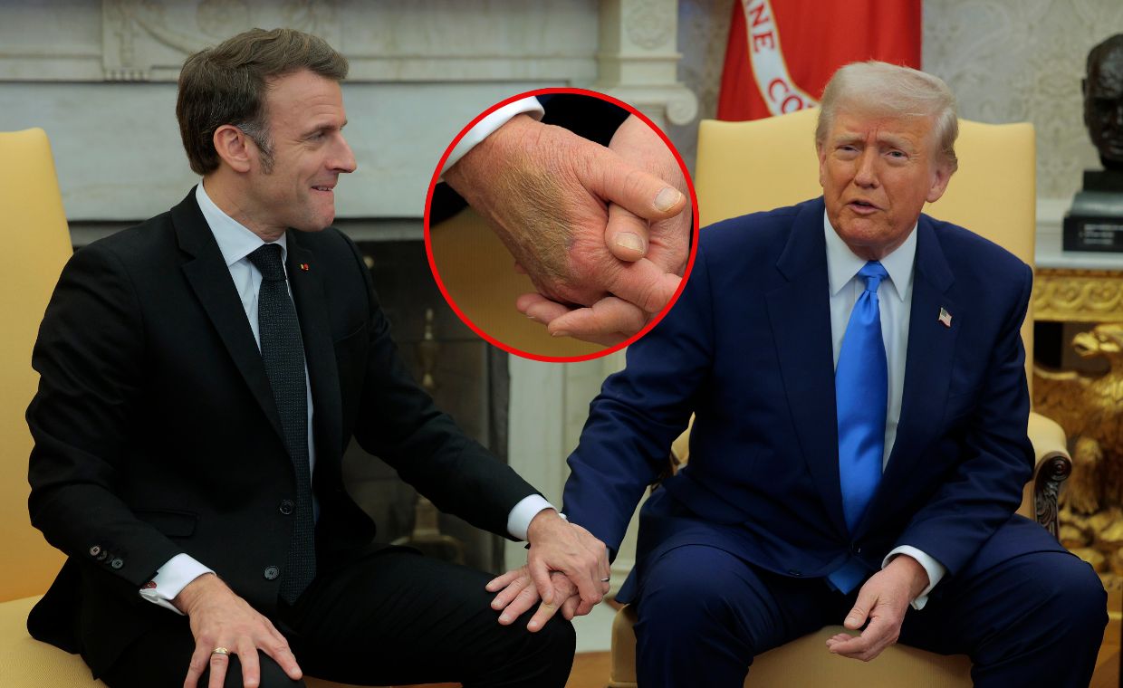 Bruise on Trump's hand overshadows key meeting with Macron