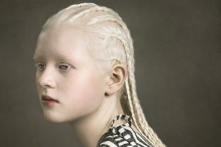 Albinizm | Fotoblogia.pl