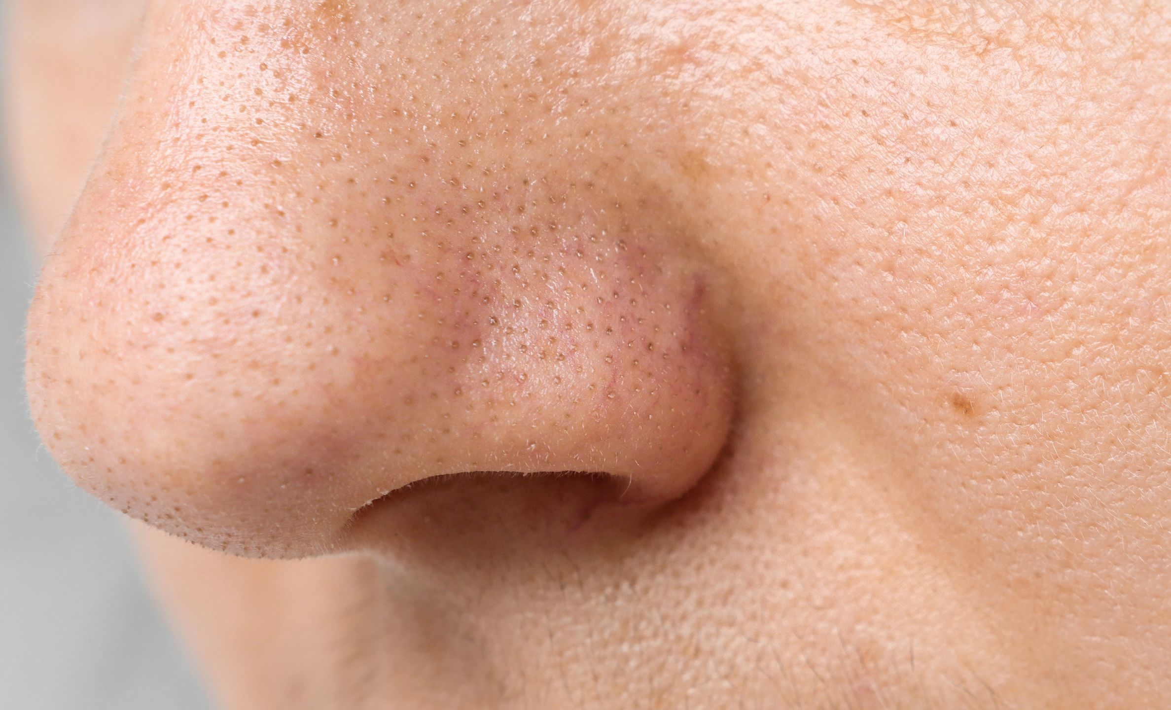 Banish blackheads: Effective homemade peel-off masks unveiled