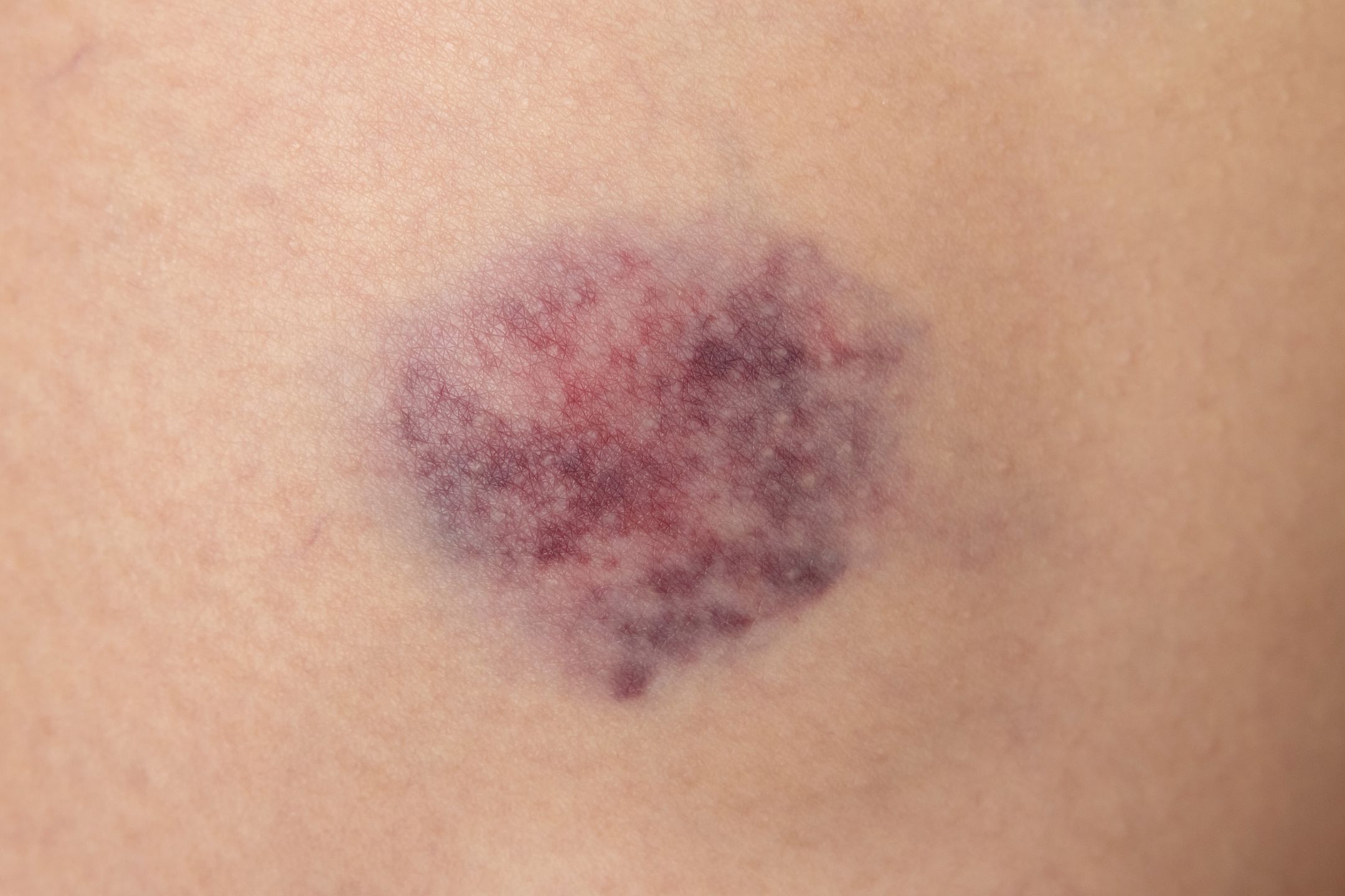 Dr. Karan Rajan warns that unexplained bruises could signal cancer Dr. Karan Rajan warns that unexplained bruises could signal cancer