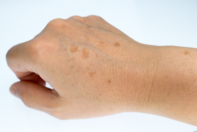 Plamy wątrobowe - przyczyny, objawy, jak pozbyć się plam ...