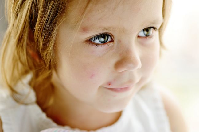 Ospa party – realne zagrożenie czy metoda na przestraszenie rodziców ...