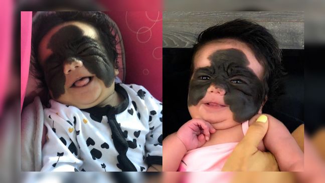 Jej córka urodziła się ze znamieniem na twarzy. Wciąż walczy z ...